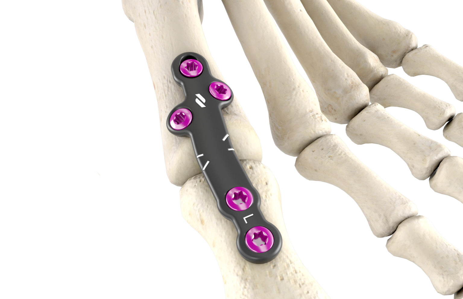 Plaques MTP longue | Novastep Ortho