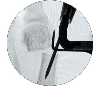 Correction MIS de l’Hallux valgus | Novastep Ortho