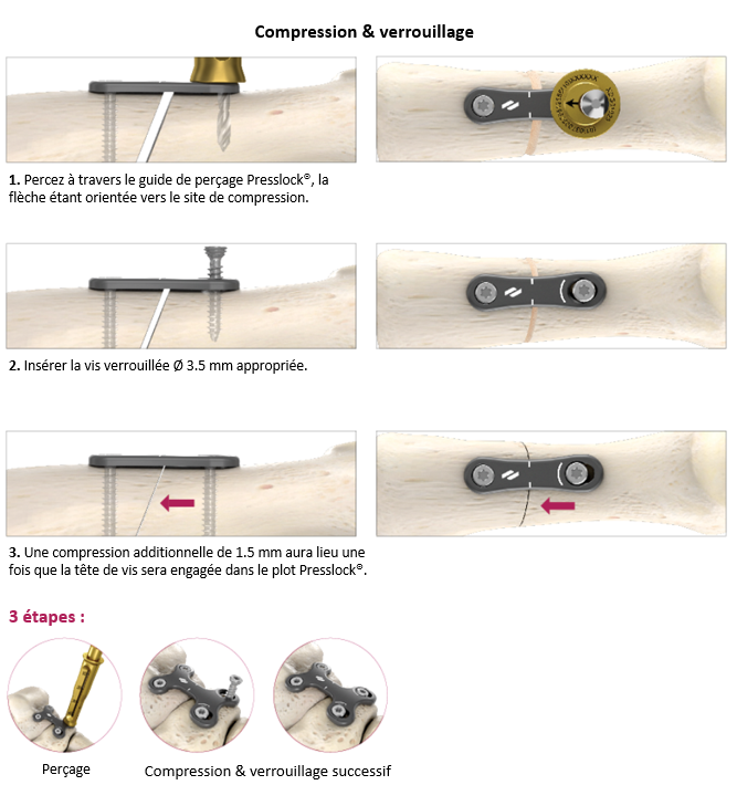 Plaques Fusion | Novastep Ortho