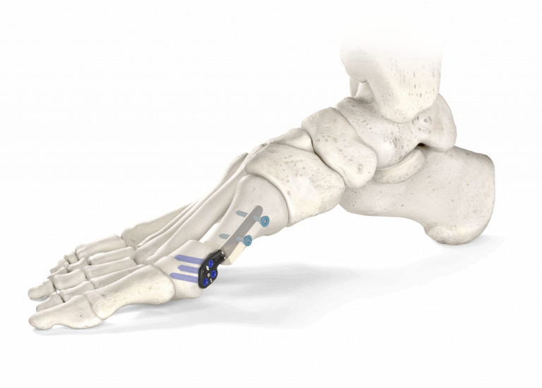 Centrolock® Academy | Novastep Ortho